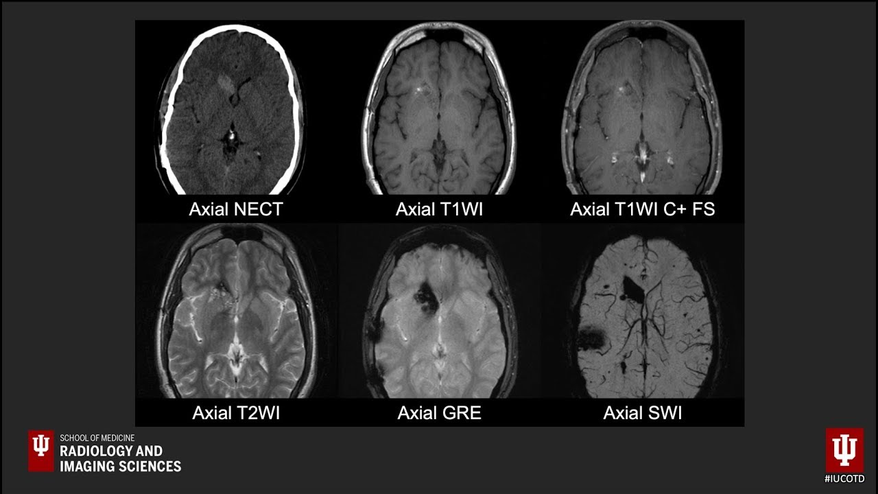Brain Case of the Day 27 - YouTube
