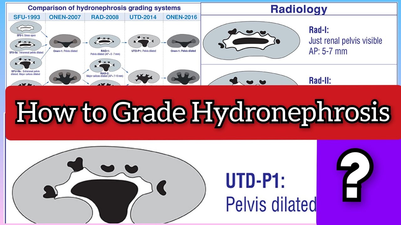 What are the different grades of Hydronephrosis on Ultrasound? #medical ...
