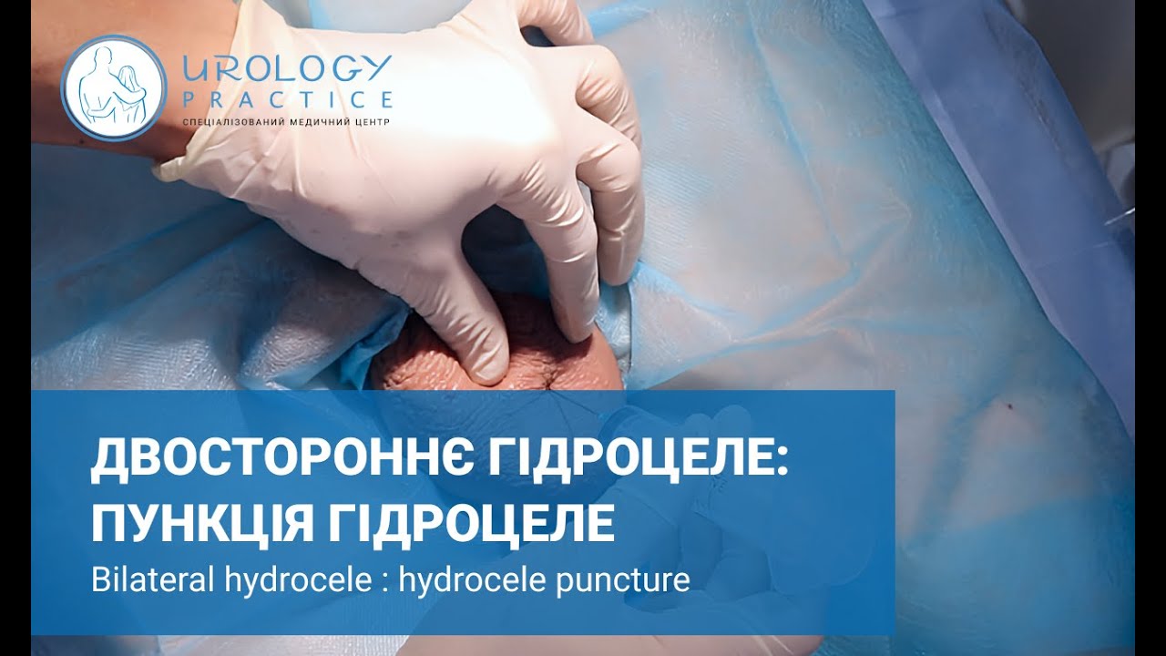 Двостороннє гідроцеле: пункція гідроцеле / Bilateral hydrocele ...