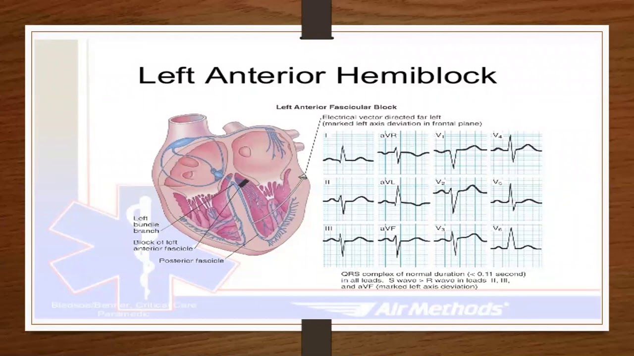 Hemiblocks and Hypertrophy - YouTube
