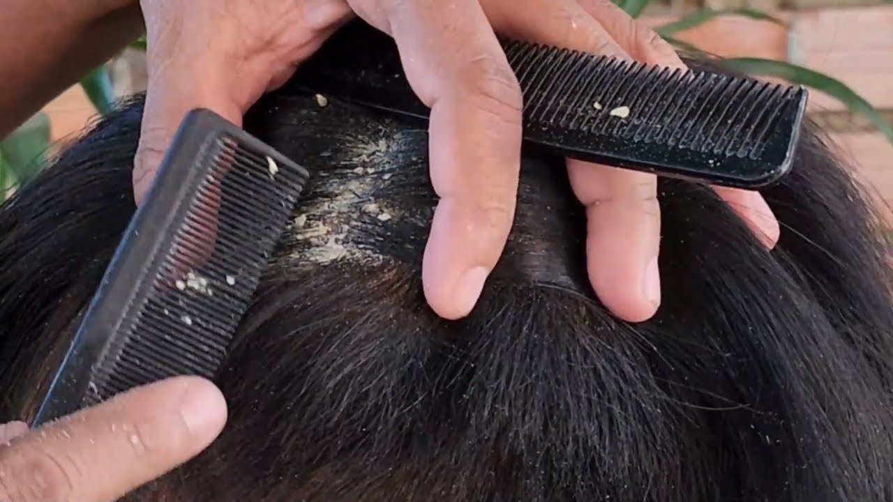 ASMR Scalp Scratching for Sleep and Relaxing Care #443 - YouTube