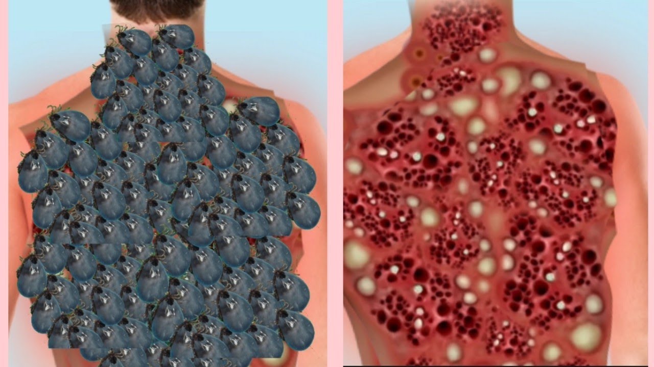 ASMR/Removal of Dog Ticks from back Neck/Severely injured Treatment ...