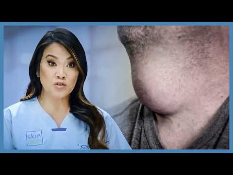 Dr Lee Removes A Neck Mass Other Doctors Have Feared! | Dr Pimple Popper