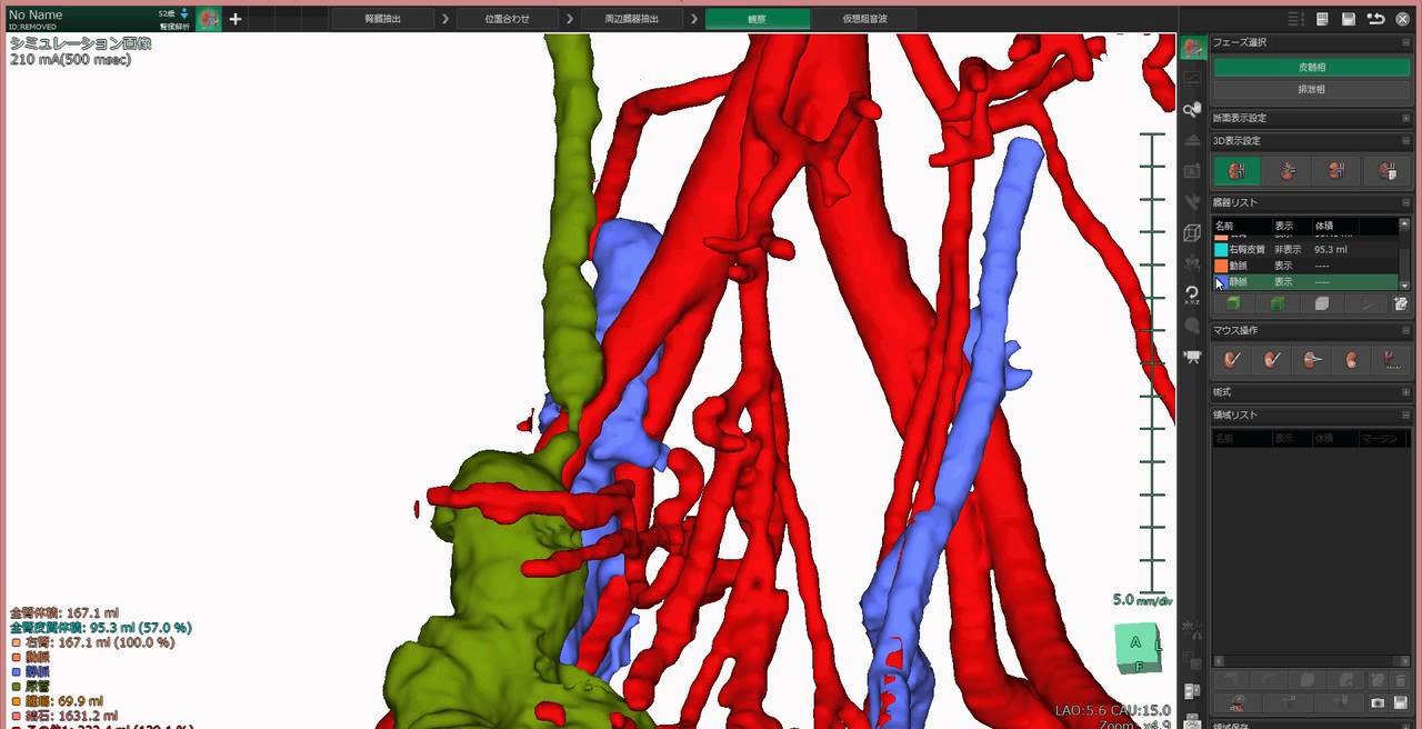 3D imaging for nephroureterectomy with resection of the Studer ...