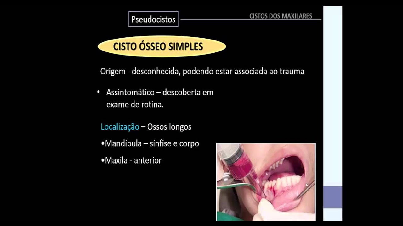 cistos dos maxilares parte 4 - YouTube