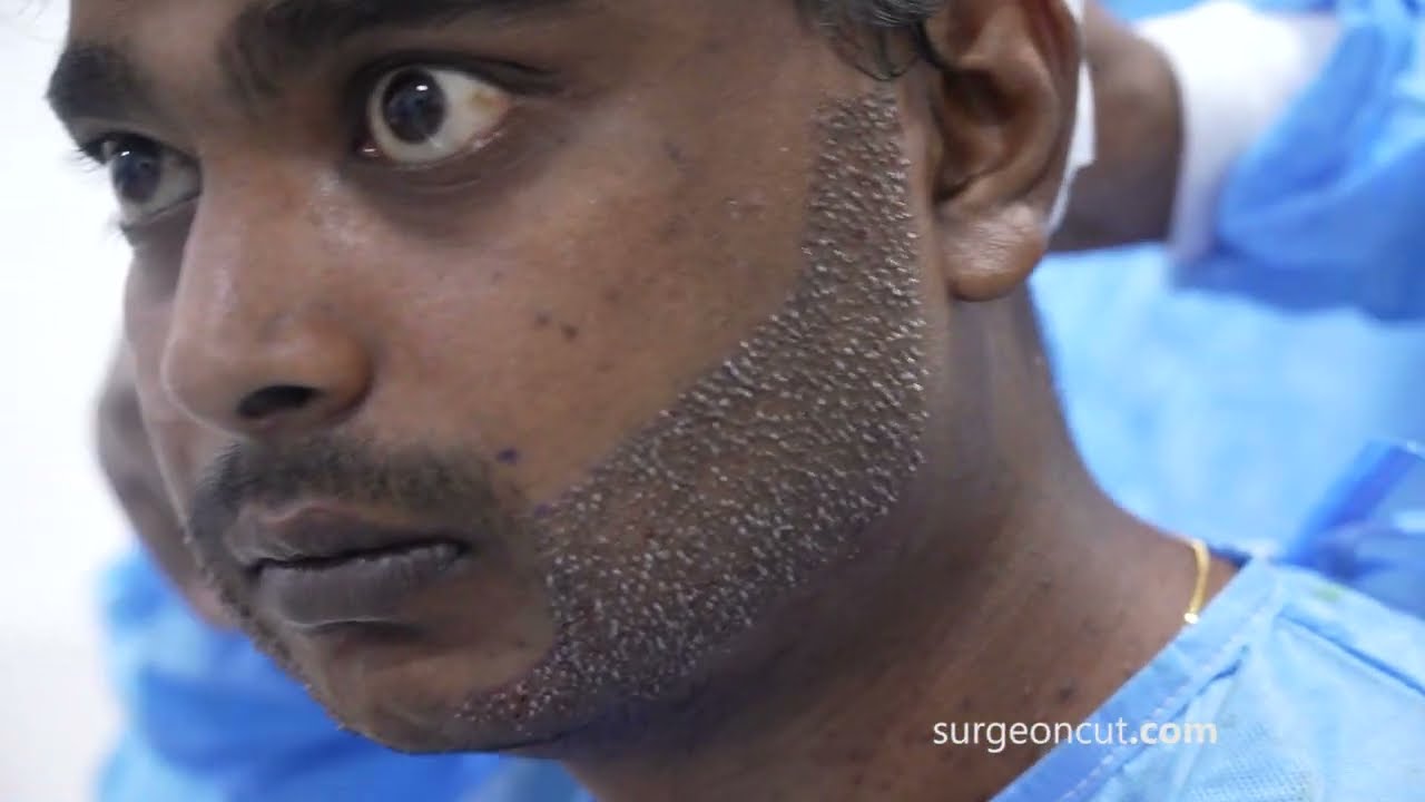 Worlds Best Beard Transplants in India - Complete Surgery - YouTube