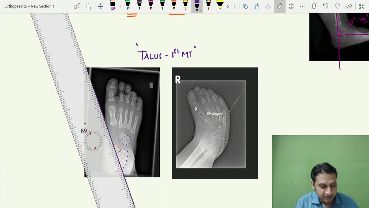 CTEV: RELEVANCE OF FOOT ANGLES - YouTube