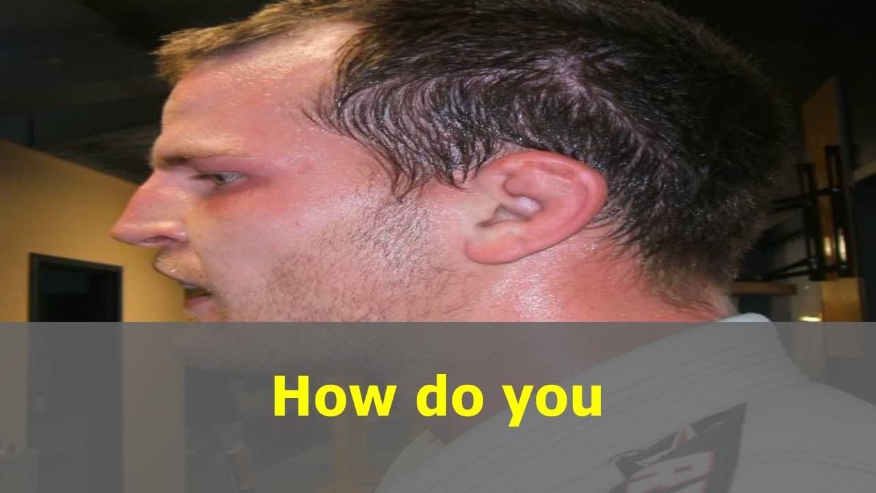 How do you develop a cauliflower ear, and is it reversible? - YouTube
