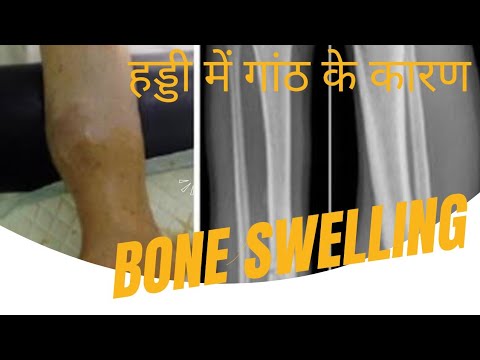 Swelling of the Bone| Bone tumour| Lump related to bones - YouTube