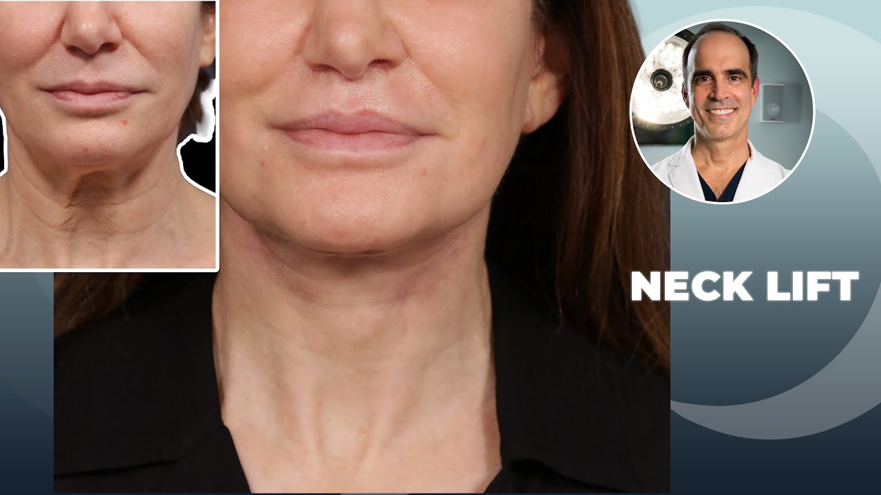 How to Fix a Sagging Neck with These 2 Simple Steps | Los Angeles - YouTube