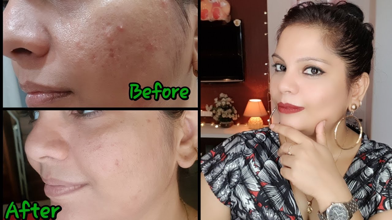 Tried & Tested | ROOP MANTRA Zero Pimple Gel & Ayurvedic Cream Review ...