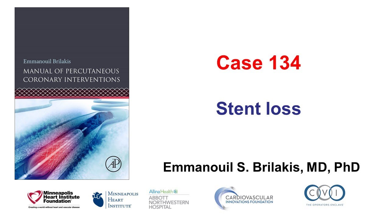 Case 134: Manual of PCI - Stent loss - YouTube