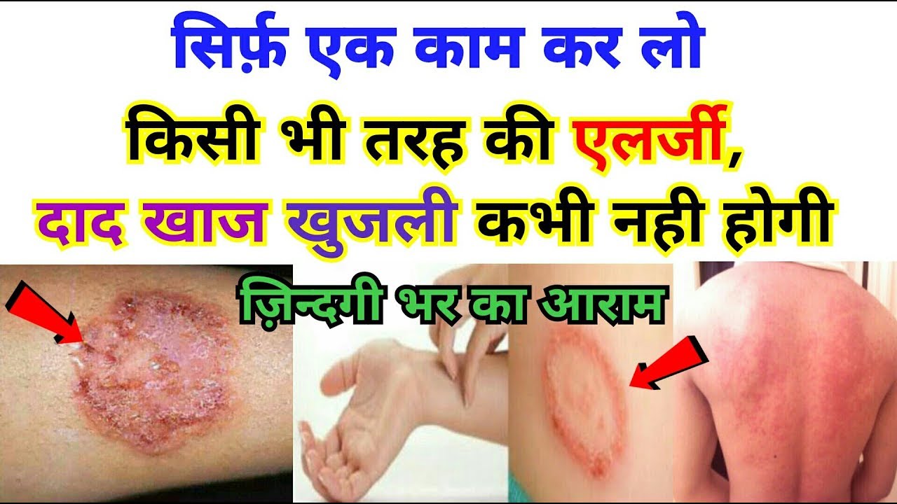 100% Guarantee Se Sirf Ek Bar Me Elargy,infection,Ringworm,Khujli,Daad ...