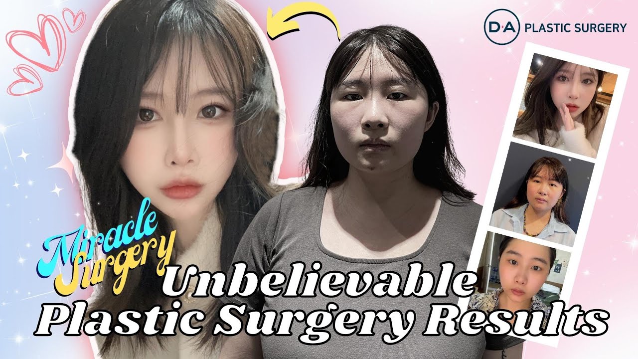 [Plastic Surgery Korea] Transform From Normal to Beautiful Just in 3 ...