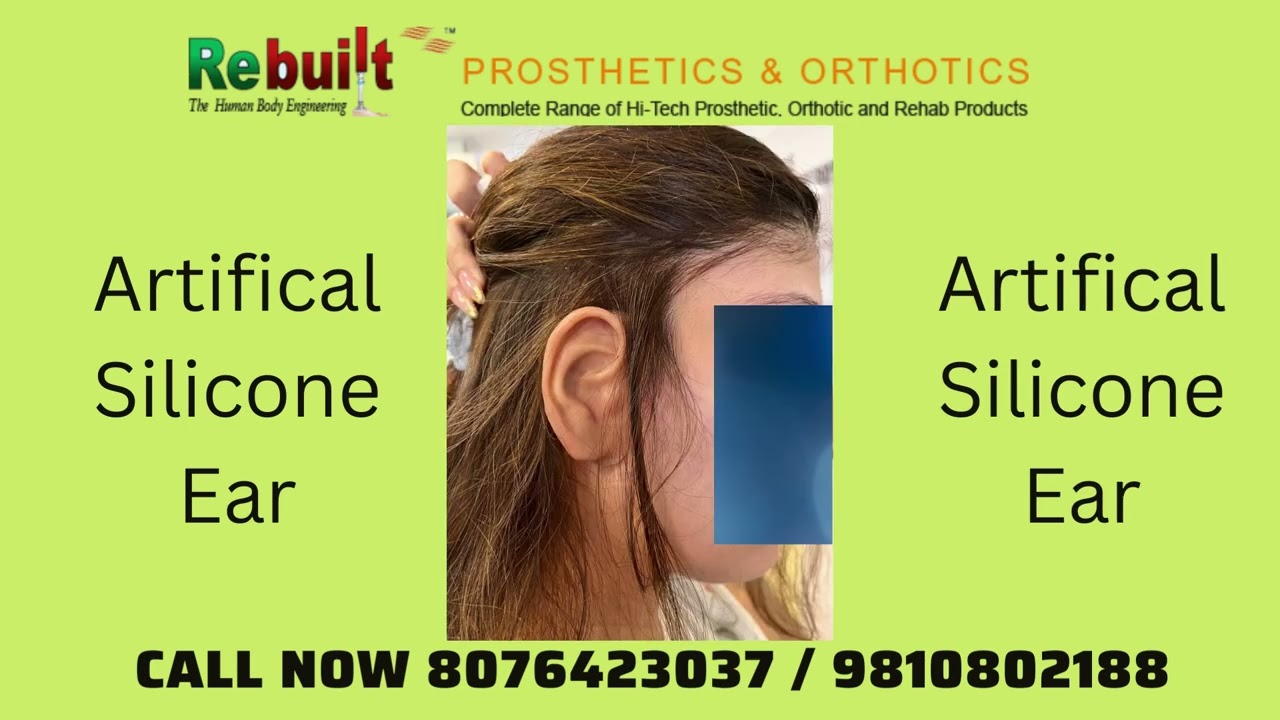 ARTIFICIAL SILICON EAR , REBUILT PROSTHETICS AND ORTHOTICS 8076423037 ...