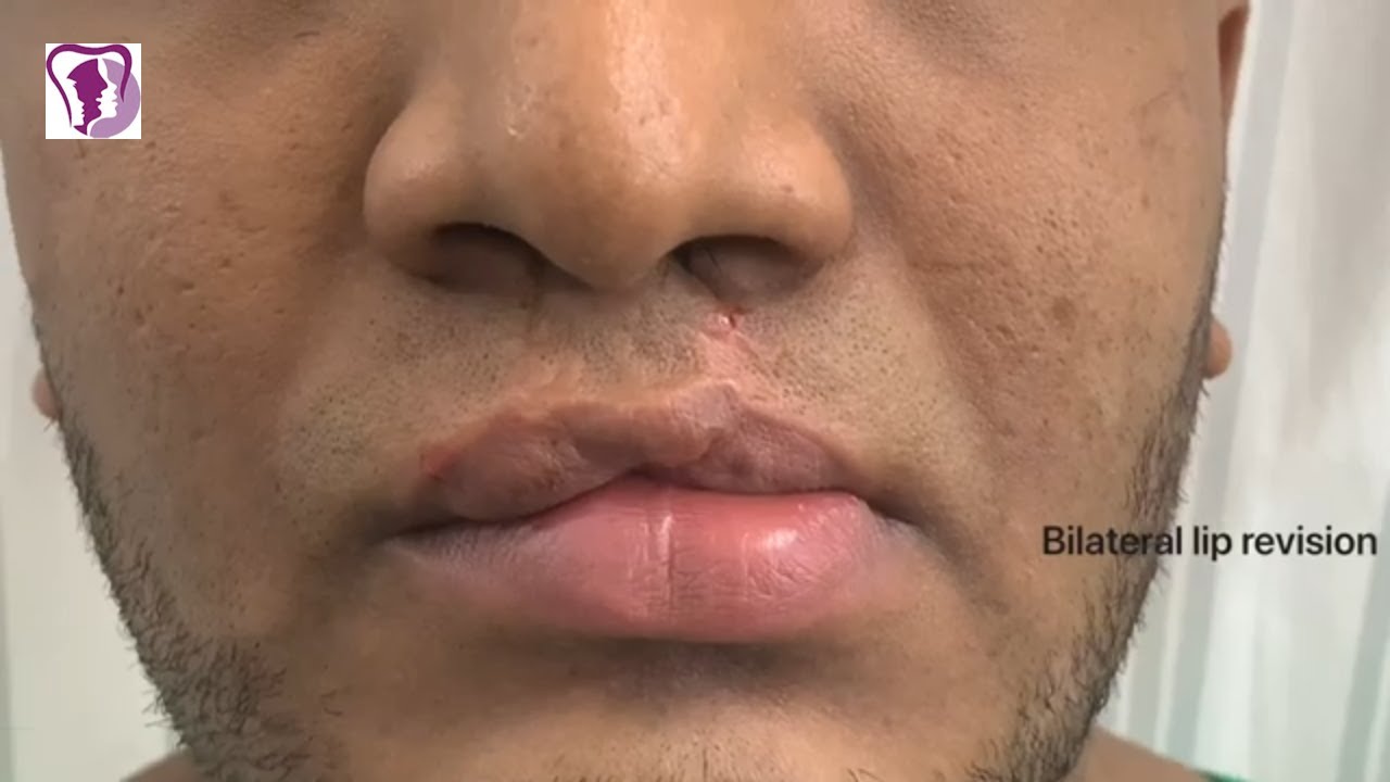 Bilateral Cleft Lip Revision With Muscle Repositioning And Scar Removal bilateral-cleft-lip-revision-with-muscle-repositioning-and-scar-removal
