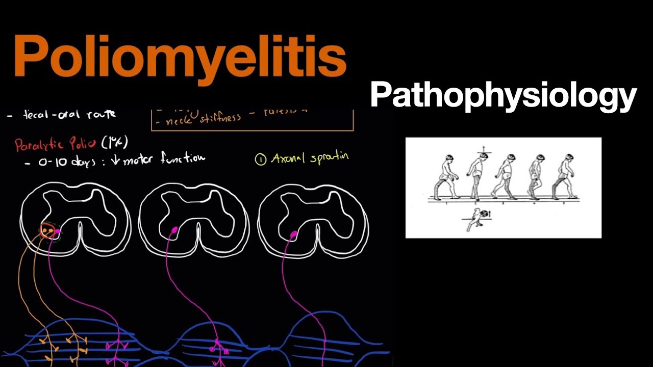 Poliomyelitis & Post-Polio Syndrome | Pathophysiology - YouTube