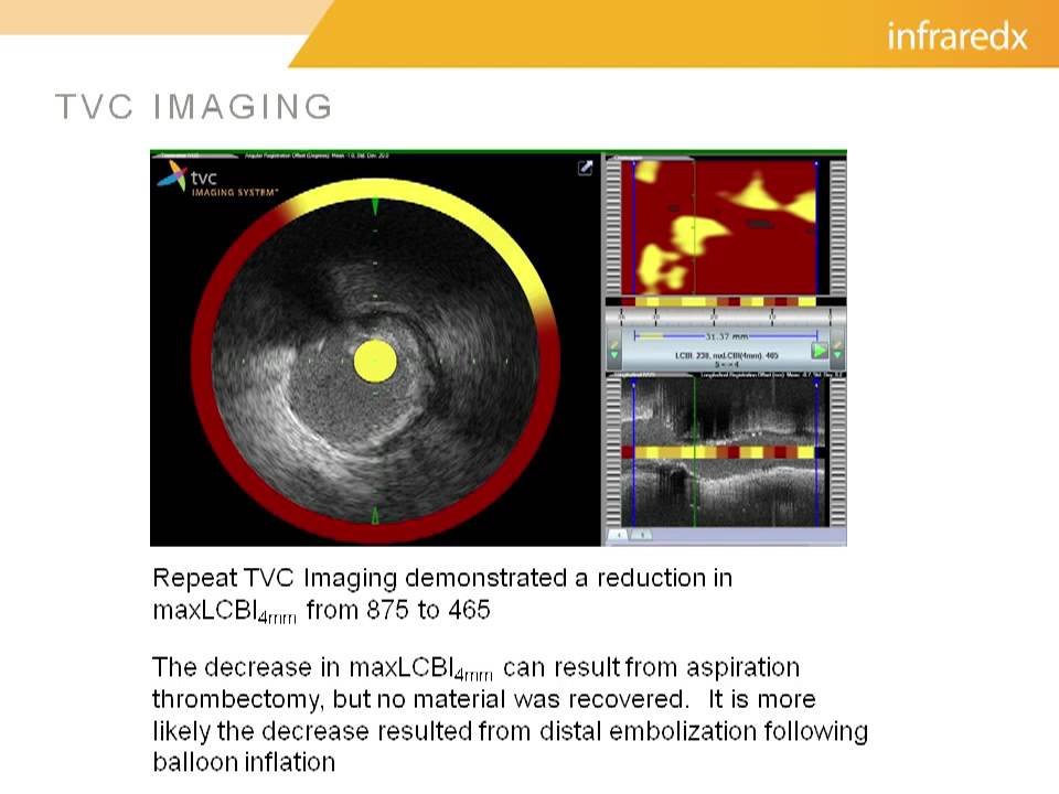 Changing Stenting Strategy Based on NIRS-IVUS Data from TVC Imaging ...
