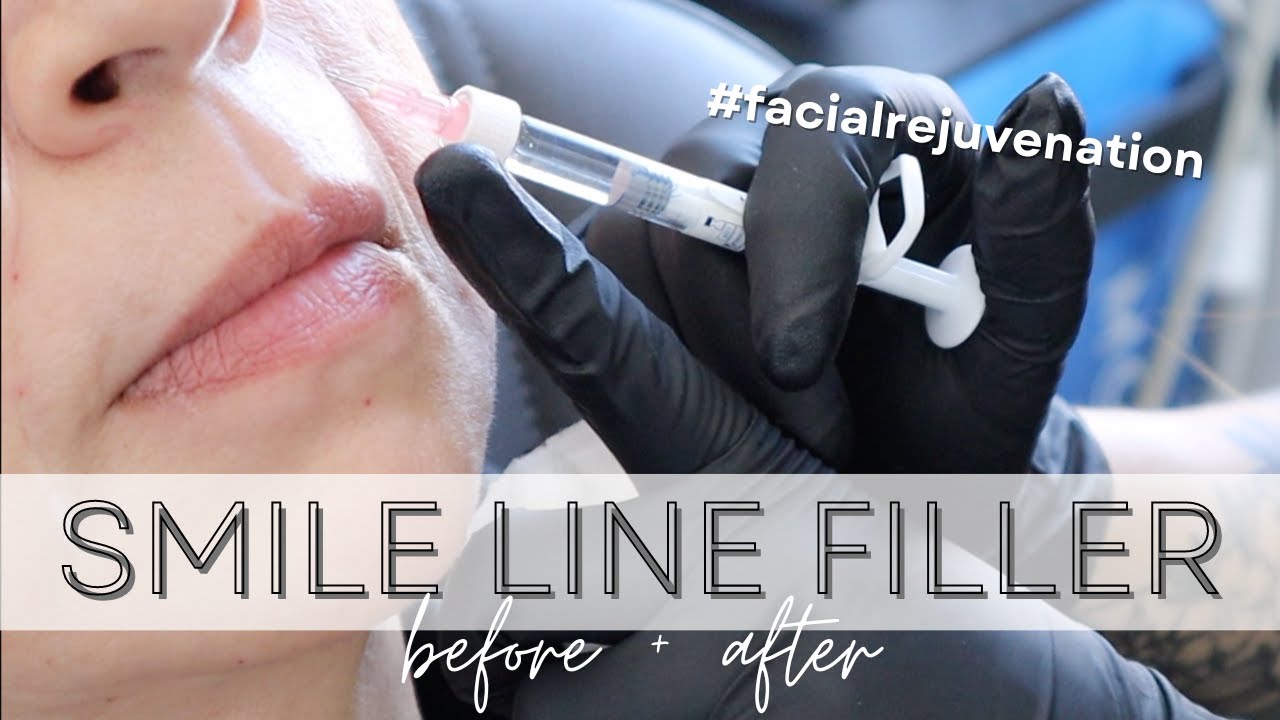 Smile Line Filler Before & After | Derma Noor Med Spa - YouTube