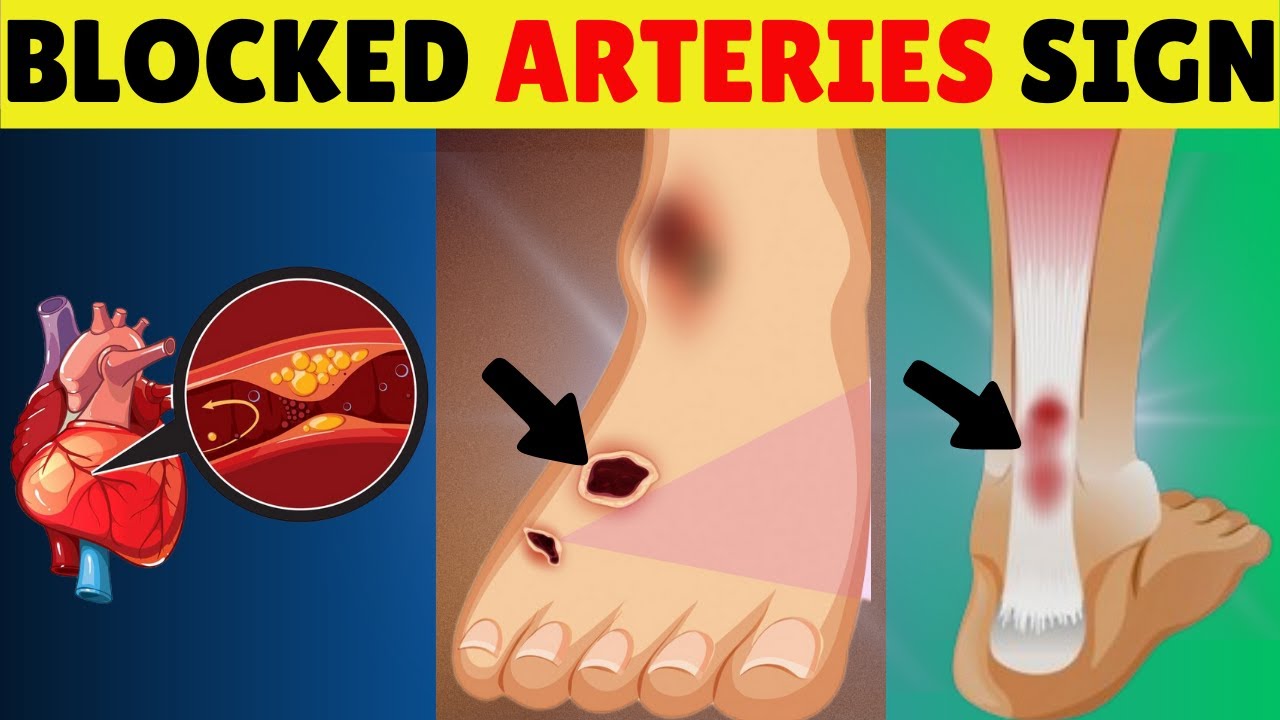 9 Warning Signs of Blocked Heart Arteries in Legs and Feet (That You ...