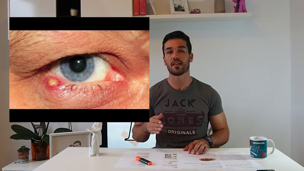 Como curar un ORZUELO - YouTube