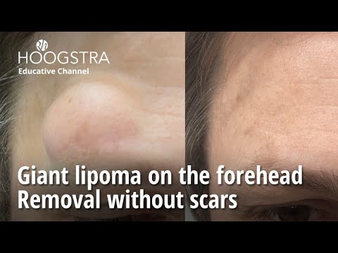 Giant lipoma on the forehead - Removal without scars - 22228 - YouTube