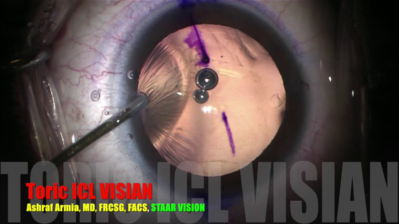Toric ICL from Visian - YouTube