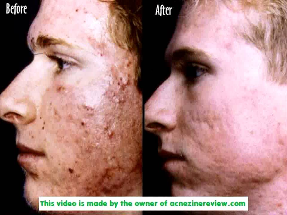 ACNEZINE - YouTube