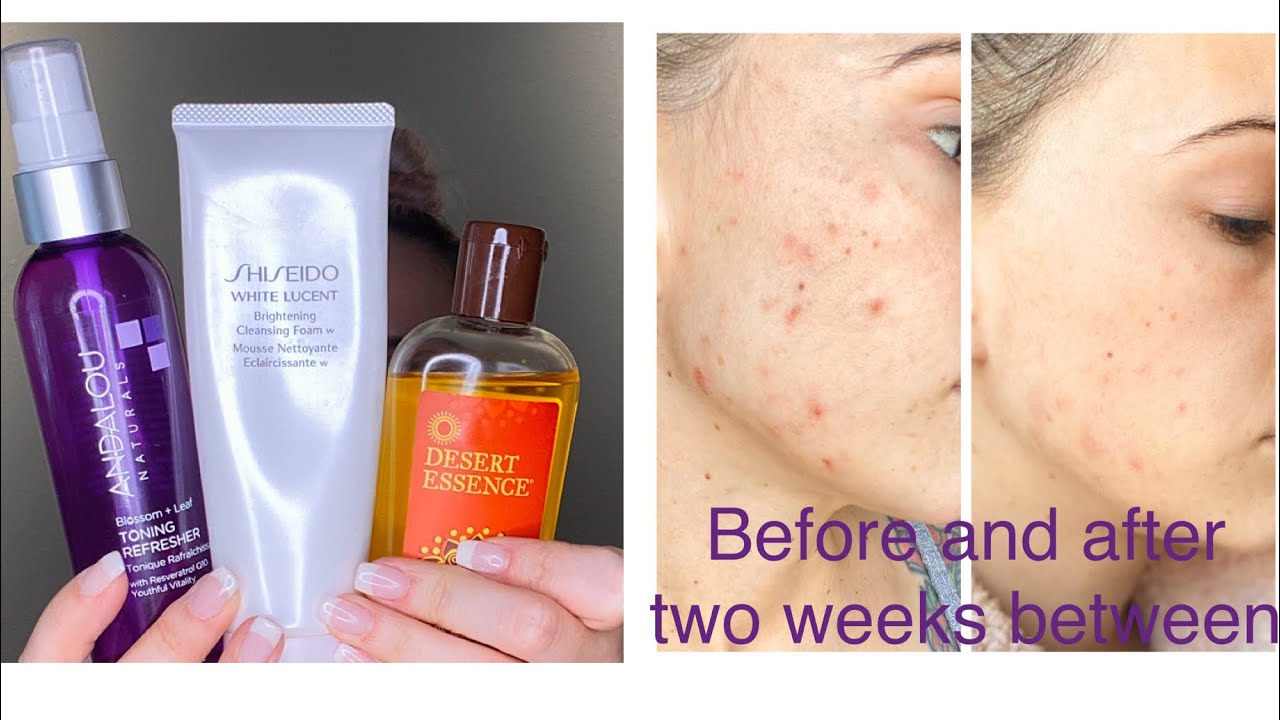 How I Healed my acne in two weeks | Products I Used - YouTube