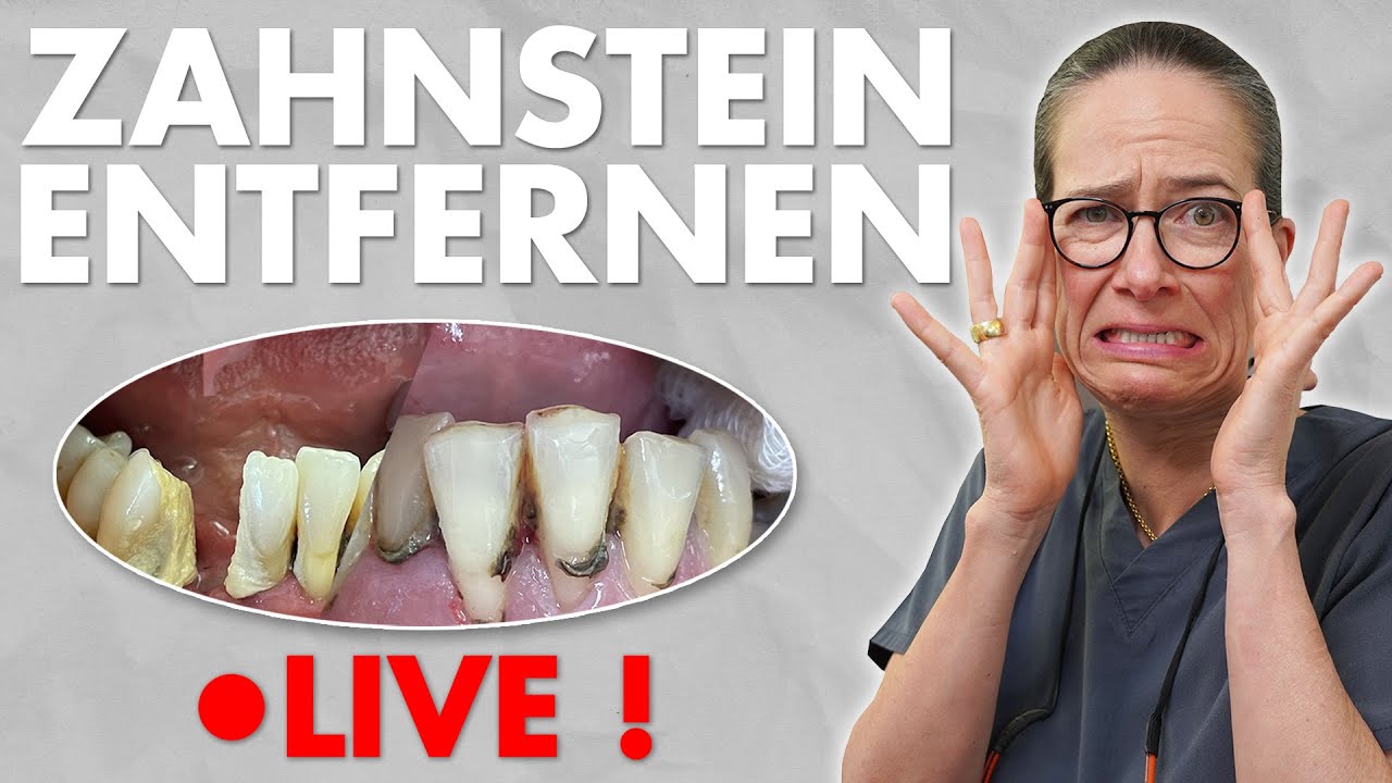 Achtung: Zahnstein bringt Mundgeruch: lass ihn entfernen - YouTube