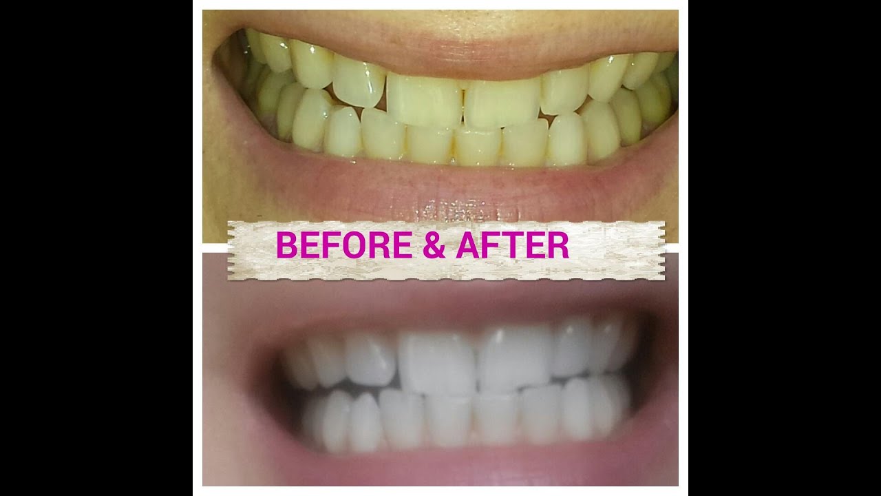 Teeth WHITENING with ONE HOUSEHOLD PRODUCT !! - YouTube