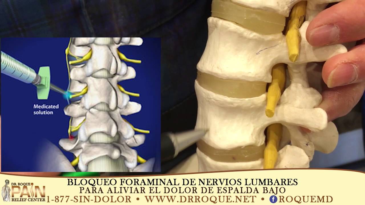 Selective Lumbar Foraminal Block, L2-L3 - YouTube