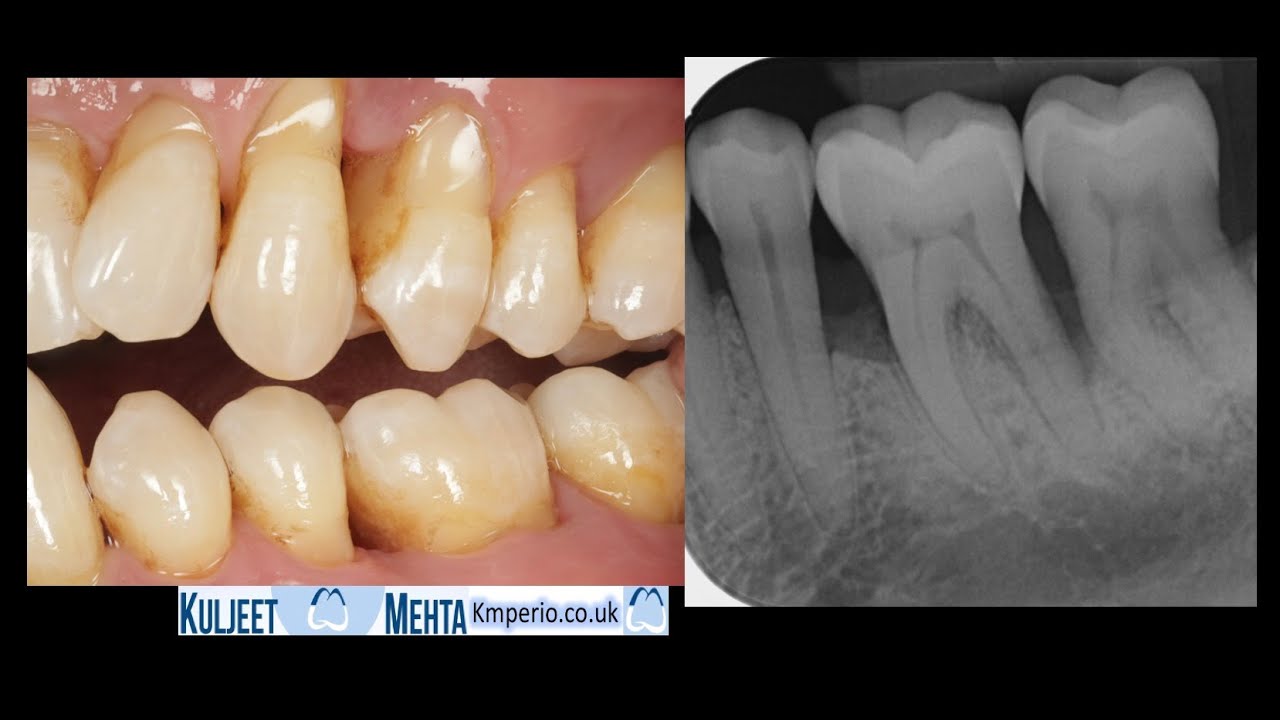 Periodontal Surgery with GTR-Lower left premolar & molar teeth - YouTube