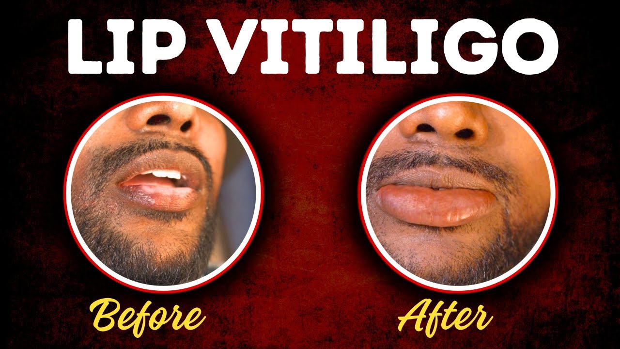 Lip Vitiligo treatment | Best vitiligo treatment in India | Bangalore ...