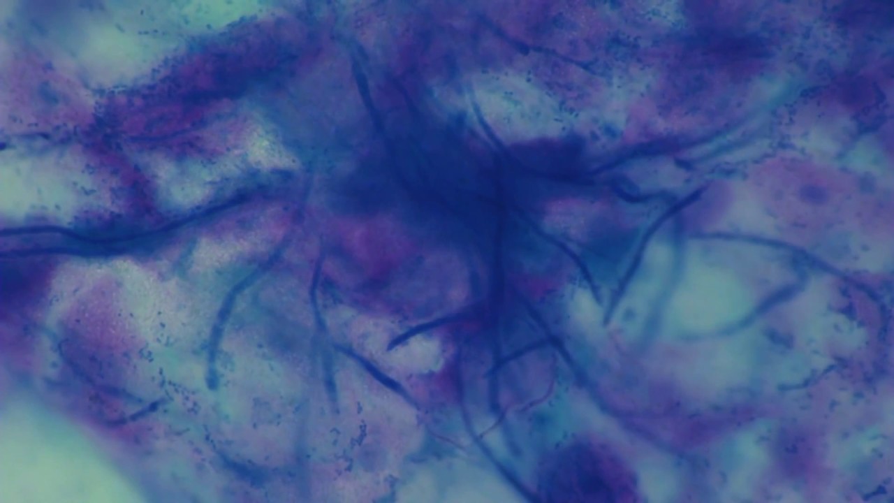 Dermatology. Balanopostitis. Candida albicans. - YouTube