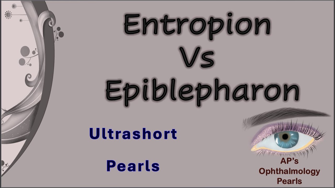 Entropion vs Epiblepharon│ Ultrashort Pearls 13 - YouTube