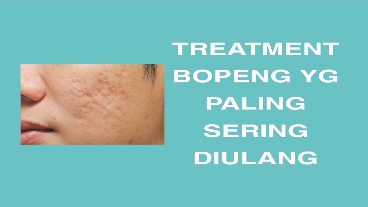 REKOMENDASI TREATMENT BOPENG DENGAN HASIL TERBAIK - YouTube