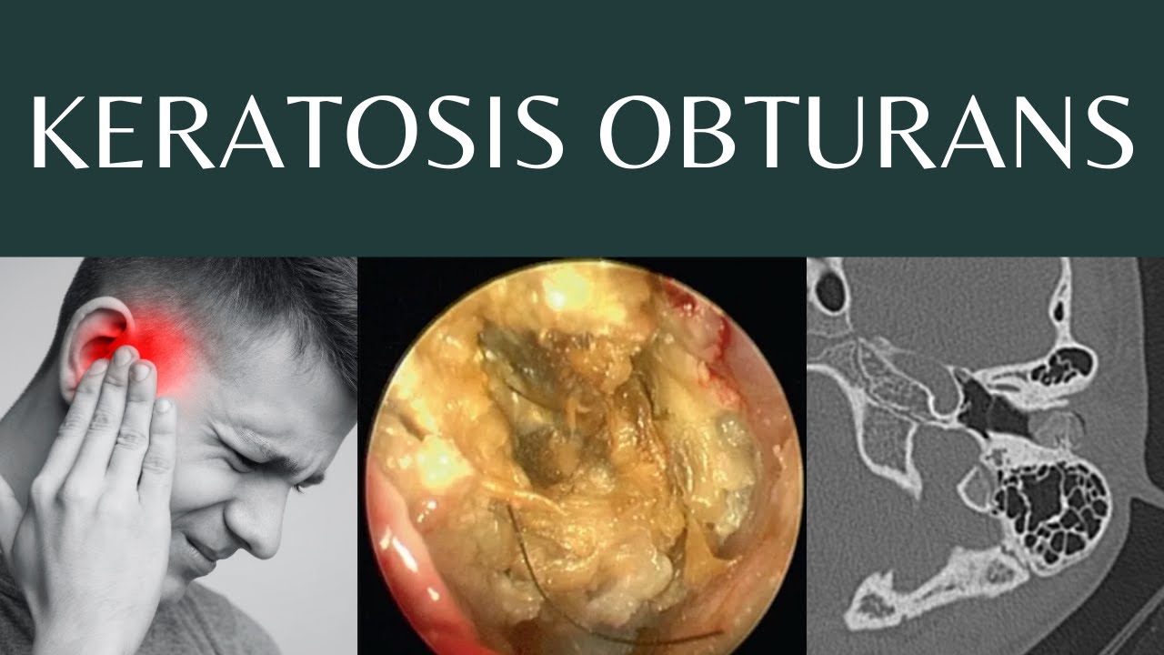 KERATOSIS OBTURANS - YouTube