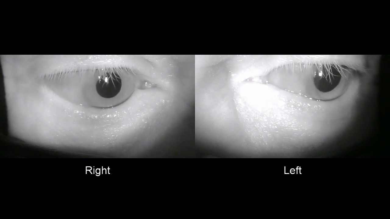 Left Beating Nystagmus (R Vestibular Hypofunction) - YouTube
