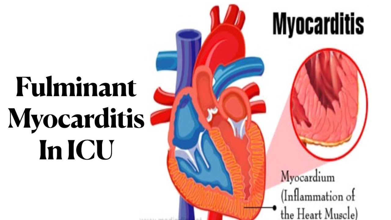 Fulminant Myocarditis in ICU - YouTube