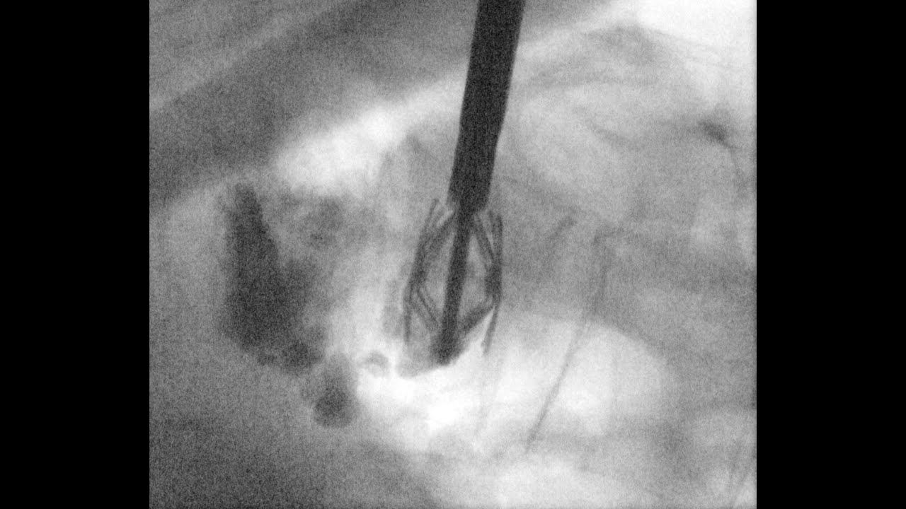 Vertebroplasty Failure Repaired By SpineJack Vertebral Augmentation ...