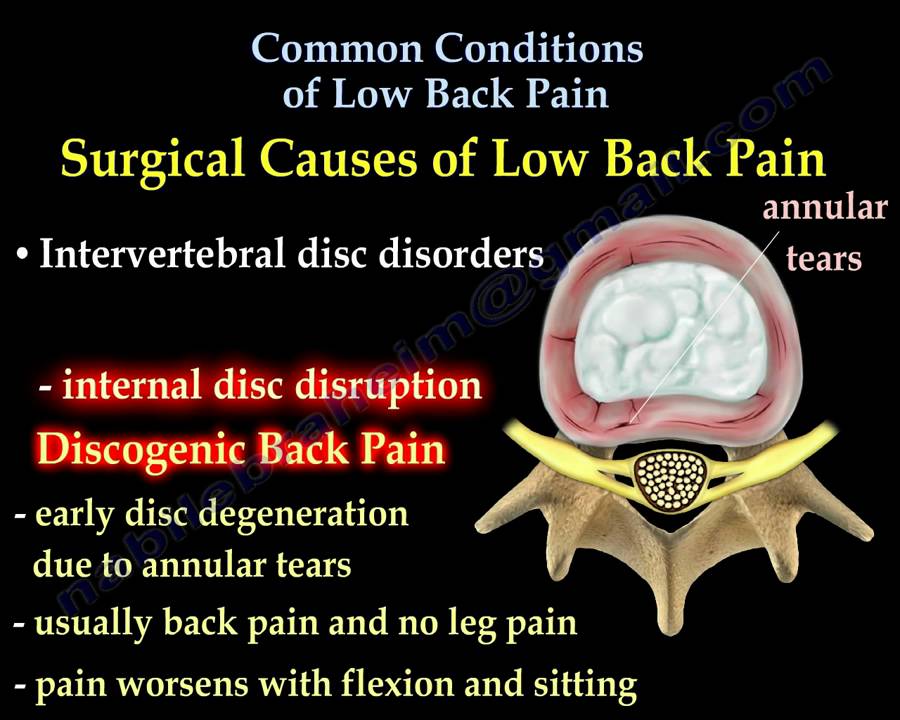 Low Back Pain,sciatica, Disc surgery- Everything You Need To Know - Dr ...