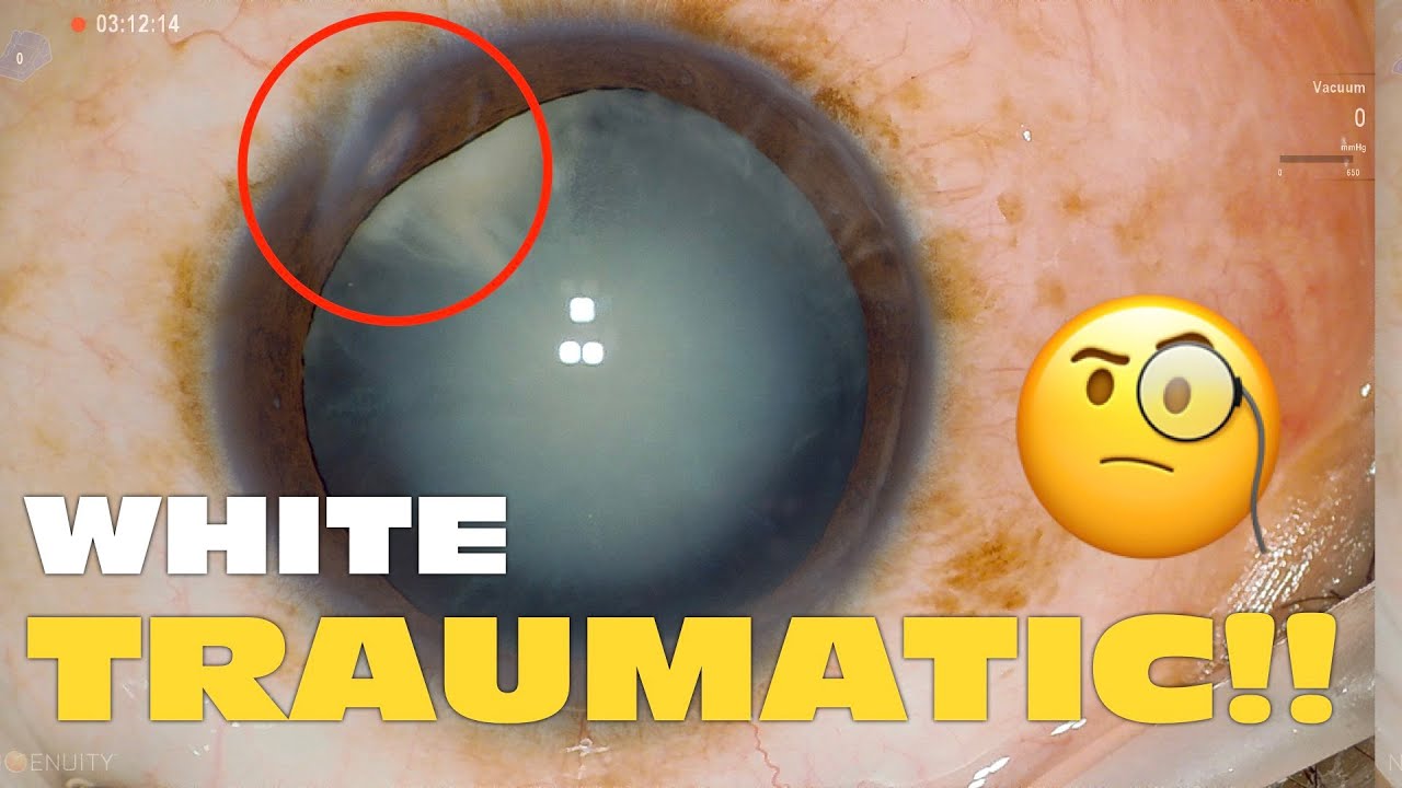 Phaco Clip #241 - Traumatic White Cataract - YouTube