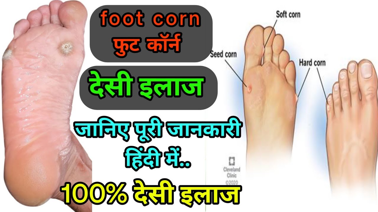 Foot Corn Treatment In Hindi YouTube foot-corn-treatment-in-hindi-youtube