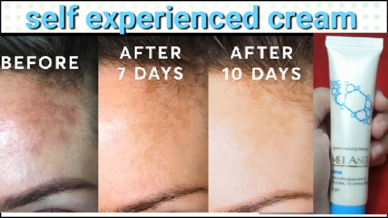 Best Cream For Freckles/Melasma/Chloasma & Dark Spots { MAGICAL CREAM ...