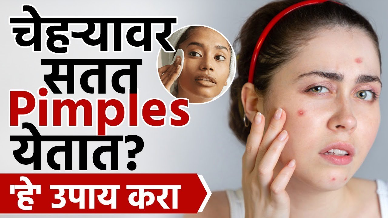 चेहऱ्यावरचे Pimples घालवण्यासाठी उपाय | How to Get Rid of Pimples ...