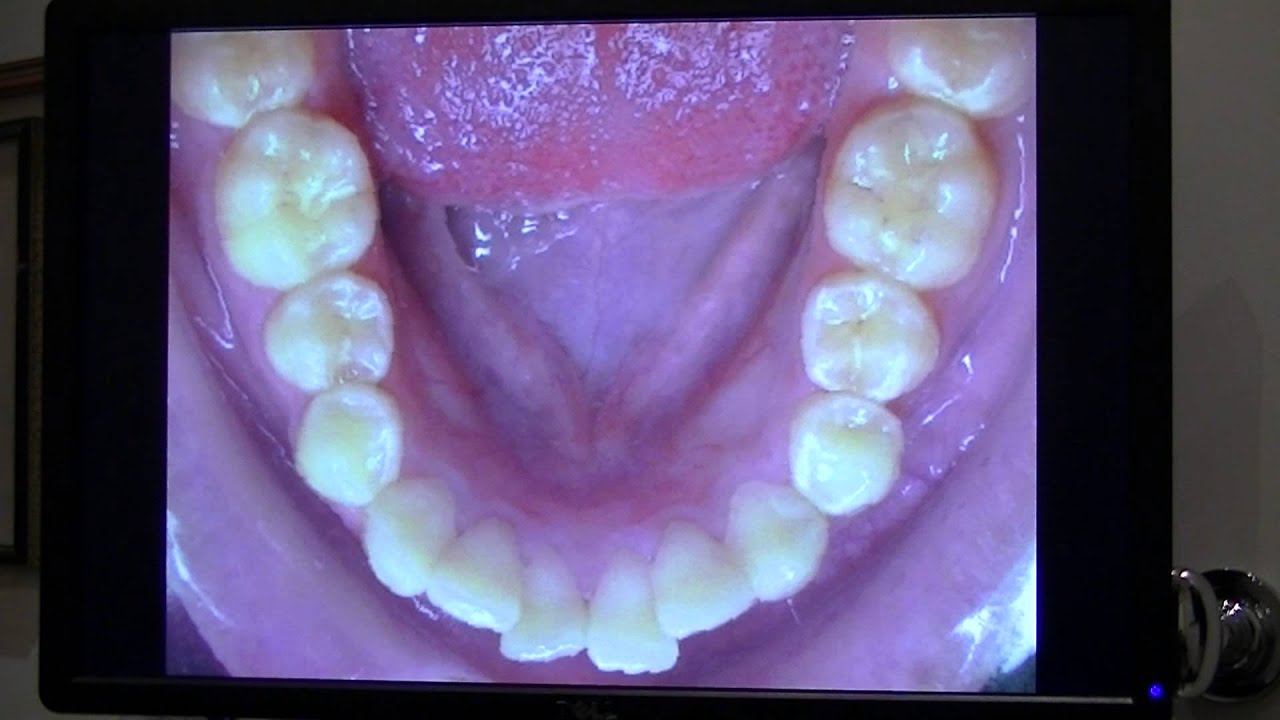 Invisalign NYC Orthodontist fixes Lower Crowding Correction for a ...