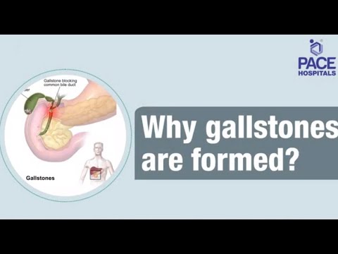 Why Gallstones (cholelithiasis ) are formed ? Dr. Phani Krishna Ravula ...