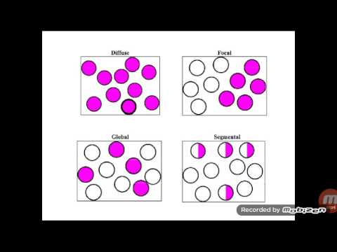 Focal segmental glomerulosclerosis - YouTube