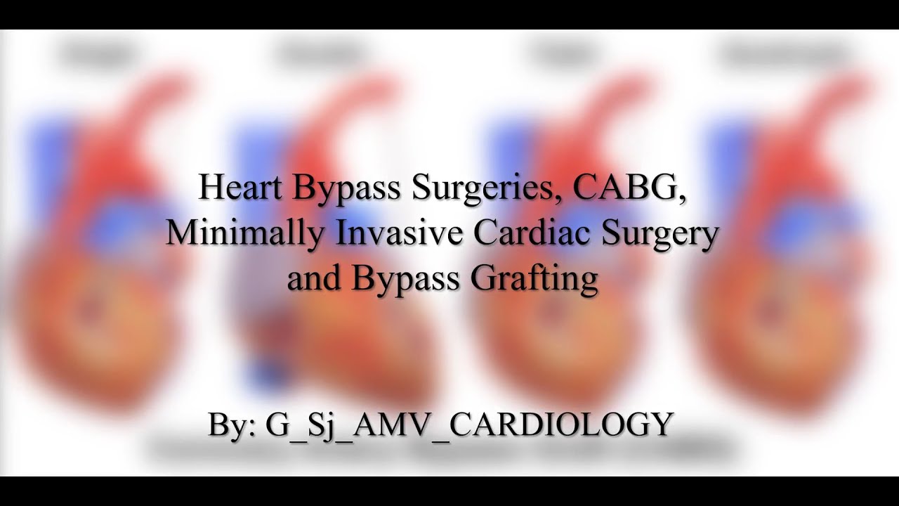 Heart Bypass Surgery, CABG, MICS and Bypass Grafting..... - YouTube